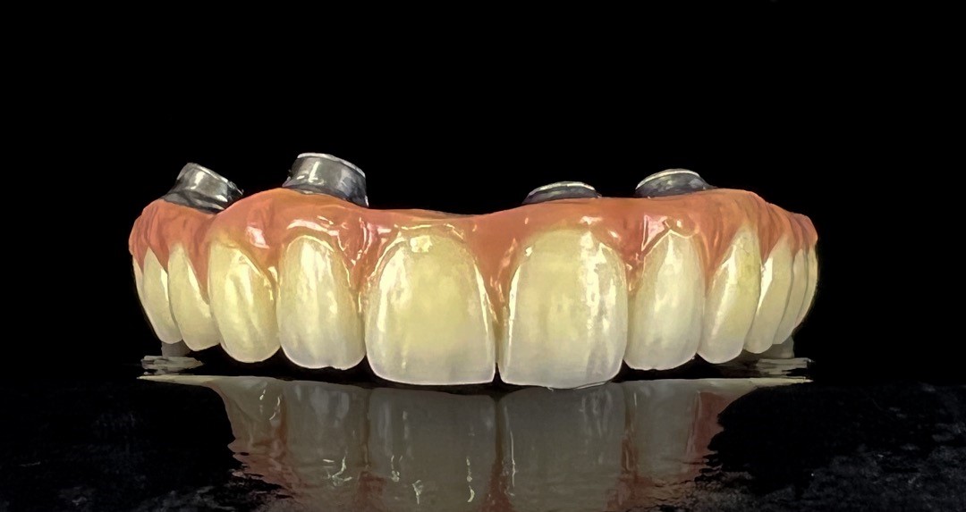 All on 4 Removable Overdentures | JJ Ceramics Dental