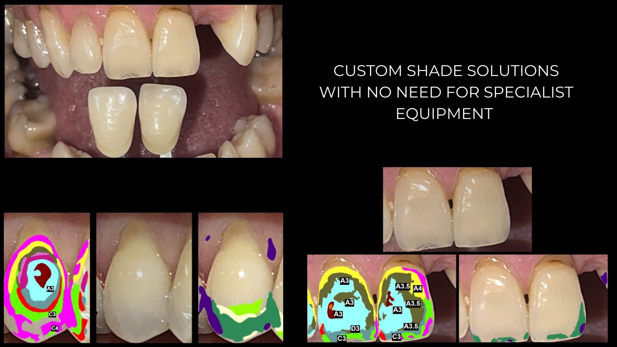 ShadeWave Custom Shade Taking | Digital Tooth Shade Matching